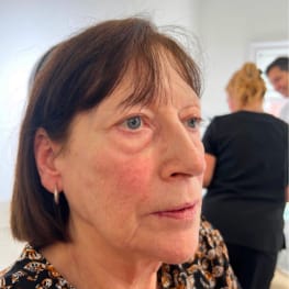 Dermal Filler - Amanda Azzopardi Aesthetics