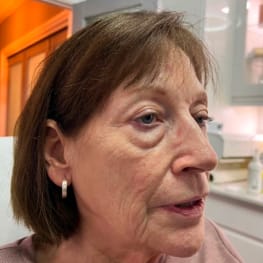 Dermal Filler - Amanda Azzopardi Aesthetics