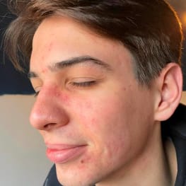 LaseMD Ultra - Amanda Azzopardi Aesthetics